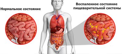 Перитонит: что это за болезнь, причины, симптомы и лечение