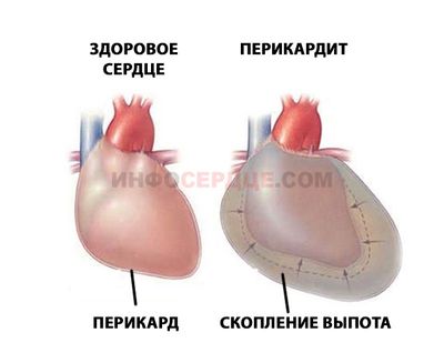 Первые признаки и симптомы инфаркта у мужчин (предынфарктное состояние ...